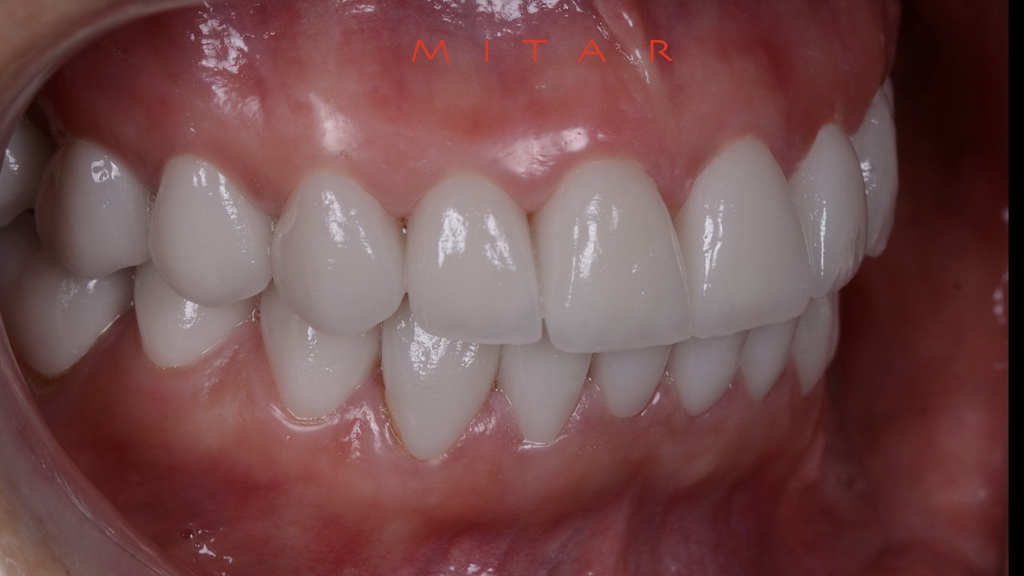 Cirkon krunice i mostovi - MT Lab