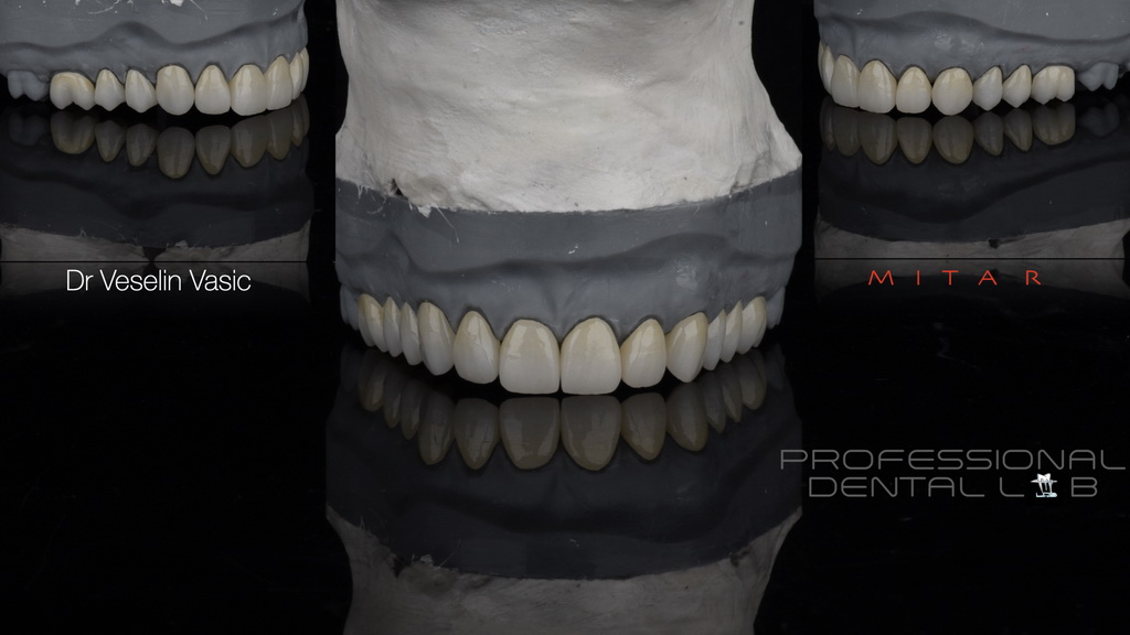 Cirkon krunice i mostovi - MT Lab