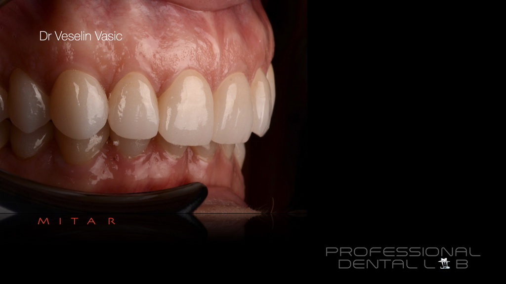 Cirkon krunice i mostovi - MT Lab