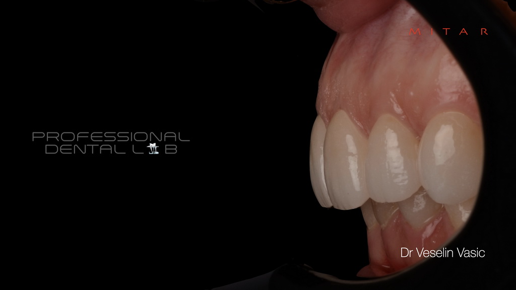 Cirkon krunice i mostovi - MT Lab