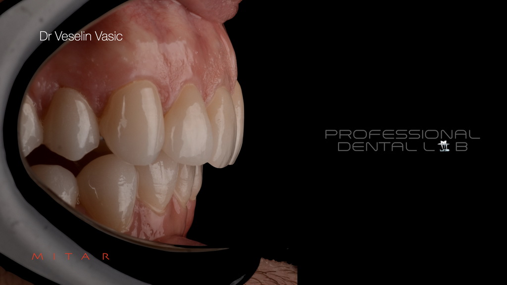 Cirkon krunice i mostovi - MT Lab