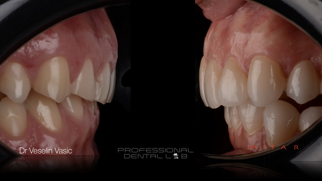 Cirkon krunice i mostovi - MT Lab