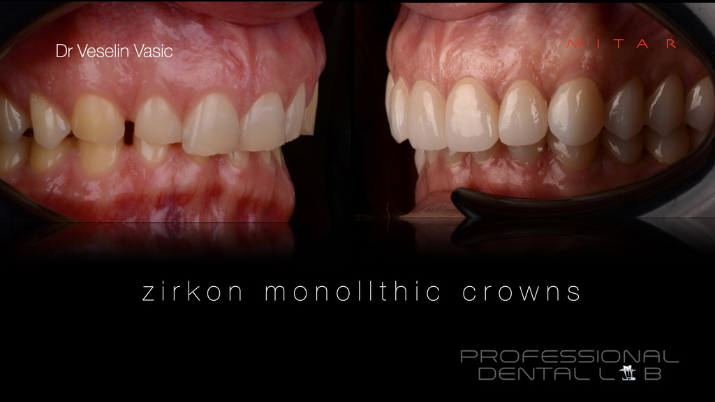 Cirkon krunice i mostovi - MT Lab