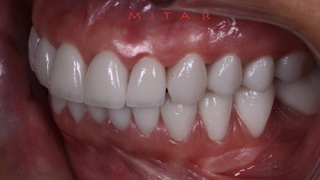 Cirkon krunice i mostovi - MT Lab