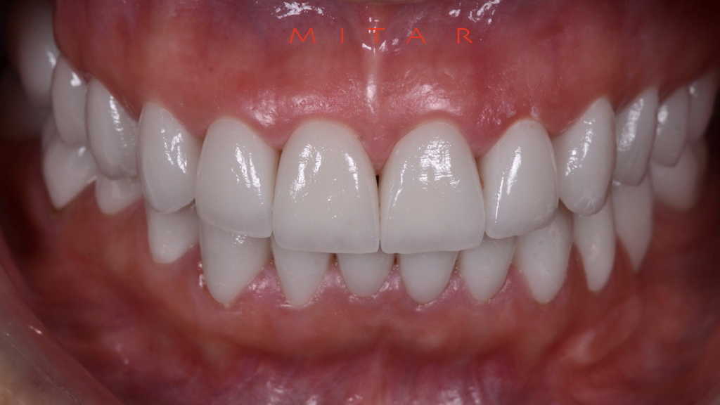 Cirkon krunice i mostovi - MT Lab