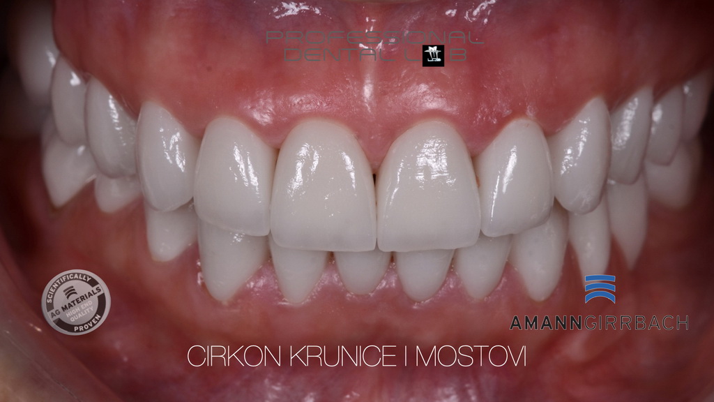 Cirkon krunice i mostovi - MT Lab