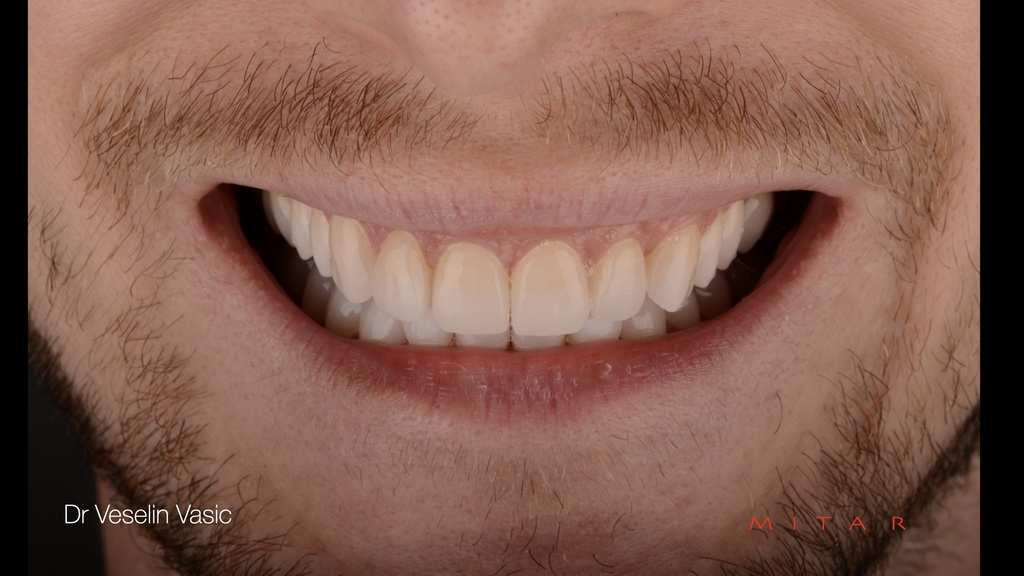 Cirkon krunice i mostovi - MT Lab